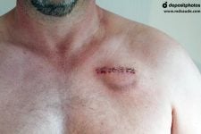 O que é marcapasso cardíaco? | MD.Saúde