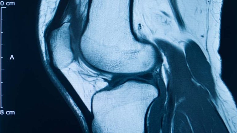 Lesão do menisco: o que é, causas, sintomas e tratamento