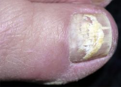 Hongos en las uñas de los pies o manos (onicomicosis)