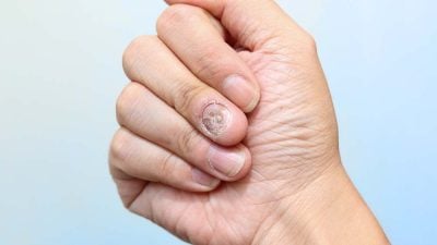 Uñero (paroniquia): causas y tratamiento de las manos y pies