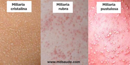 ¿Qué es la miliaria (sarpullido por calor en bebés)?