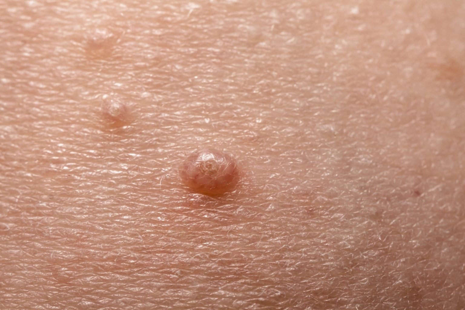 Fotos de molusco contagioso