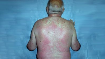 Nefrite intersticial: o que é, causas e tratamento