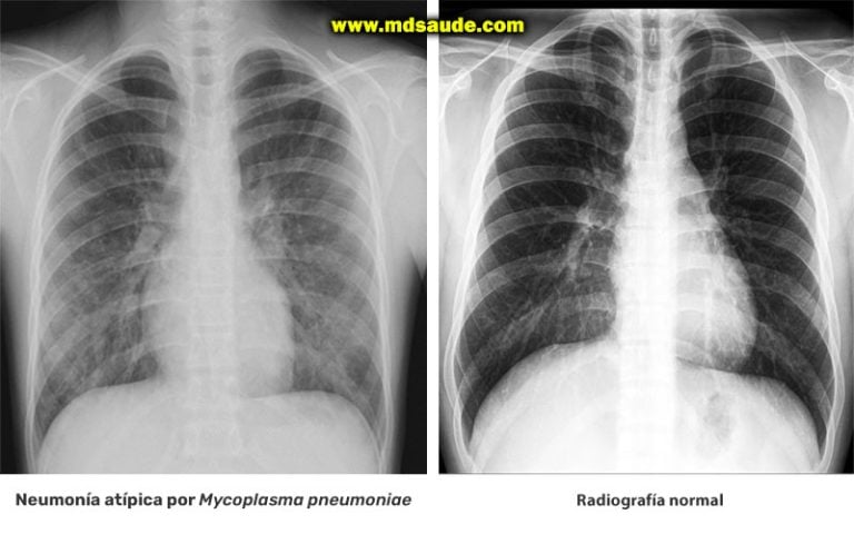 Neumonía atípica: qué es, síntomas y tratamiento