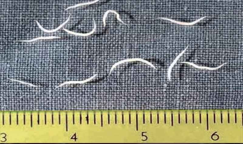 Oxiuríase (enterobíase) - Infecção pelo Enterobius vermicularis • MD.Saúde