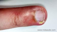 Paronychia (Nail Fold Infection): Causes and Treatment