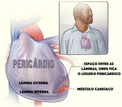 Pericardite: o que é, sintomas, causas e tratamento