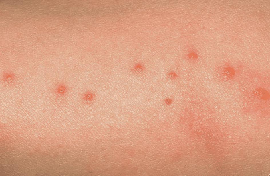 Picada De Percevejo é Perigoso - RETOEDU