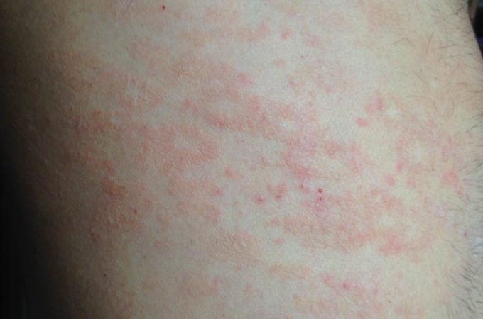 URTICÁRIA - Causas, sintomas e tratamento - MD.Saúde