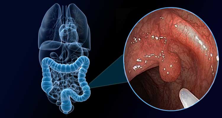 Pólipos Intestinais Sintomas Risco De Câncer E Tratamento