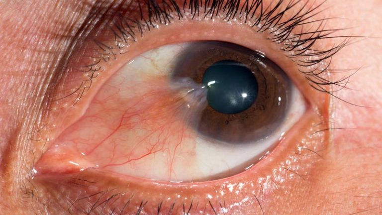 26 causas de olho vermelho e irritado (com fotos)