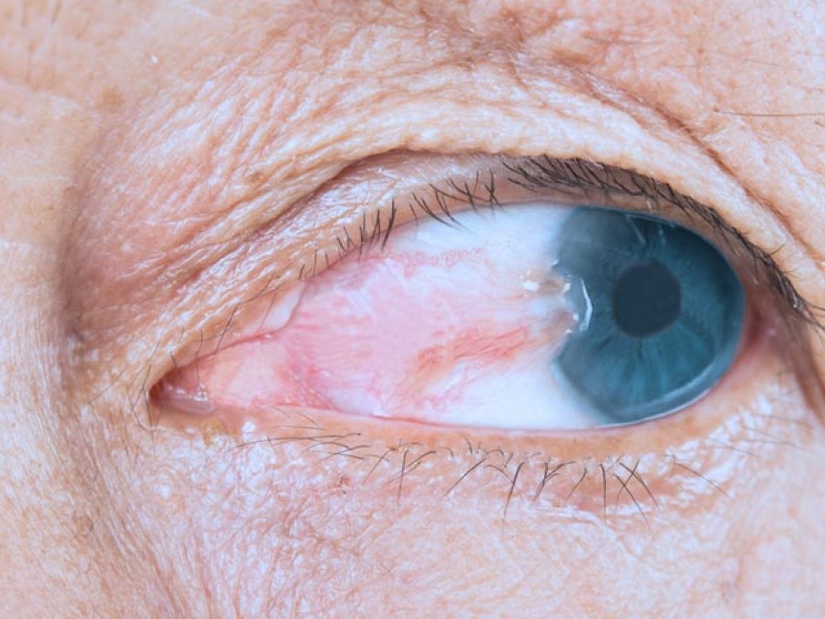 Doenca Ocular Do Pterigio Pterígio é Um Tumor?