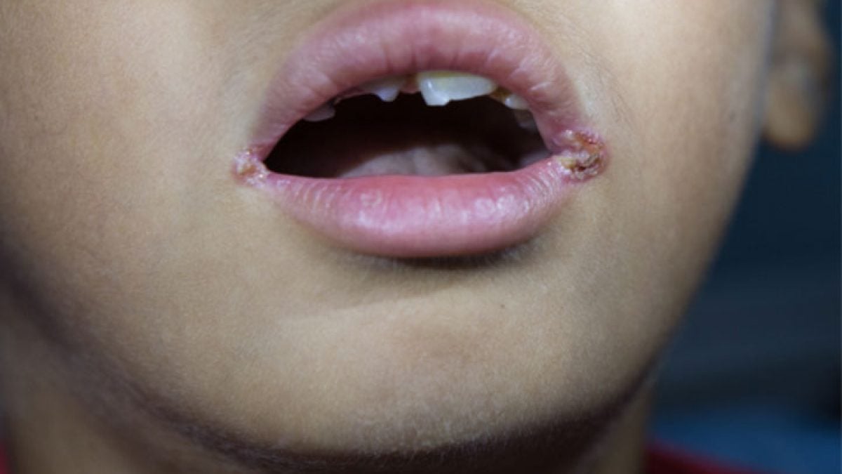 Queilite Angular Em Criancas