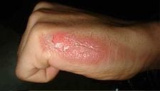 Queimadura | Graus, tipos, imagens e tratamento