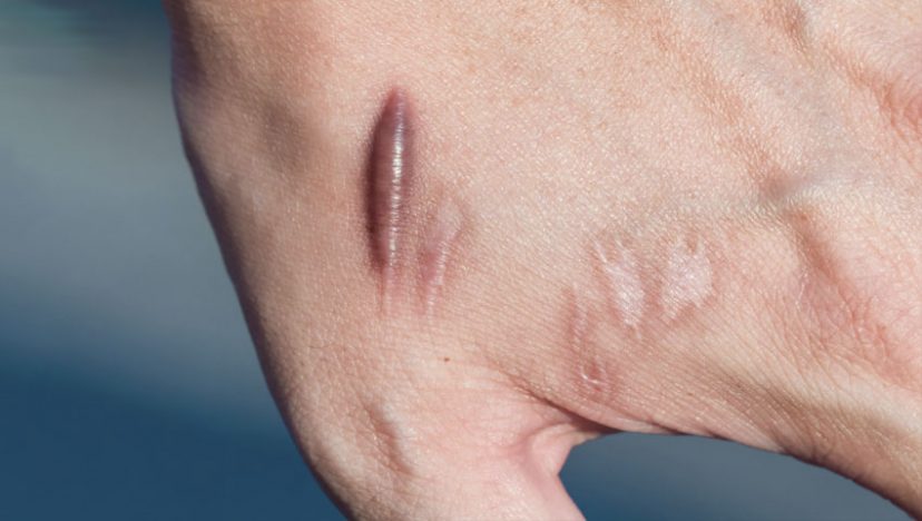 Melanose solar (mancha senil) | Sintomas e tratamento