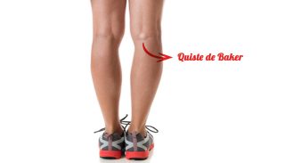 Quiste de Baker - Causas, síntomas y tratamiento • MD.Saúde