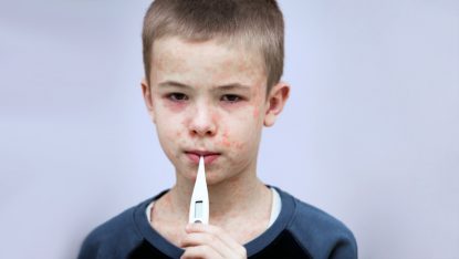 Febre | O que é, causas, sintomas e tratamento