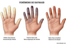Fenômeno de Raynaud: o que é, causas, sintomas e tratamento