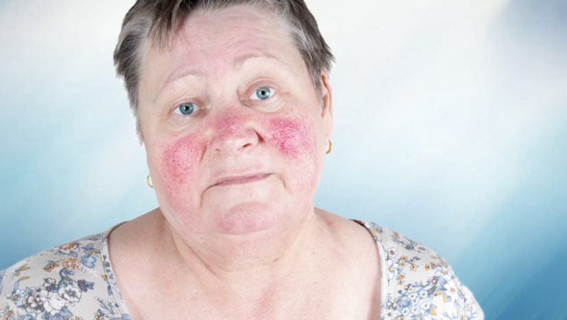 Rosácea (acne rosácea) | O que é, tipos, causas e tratamento
