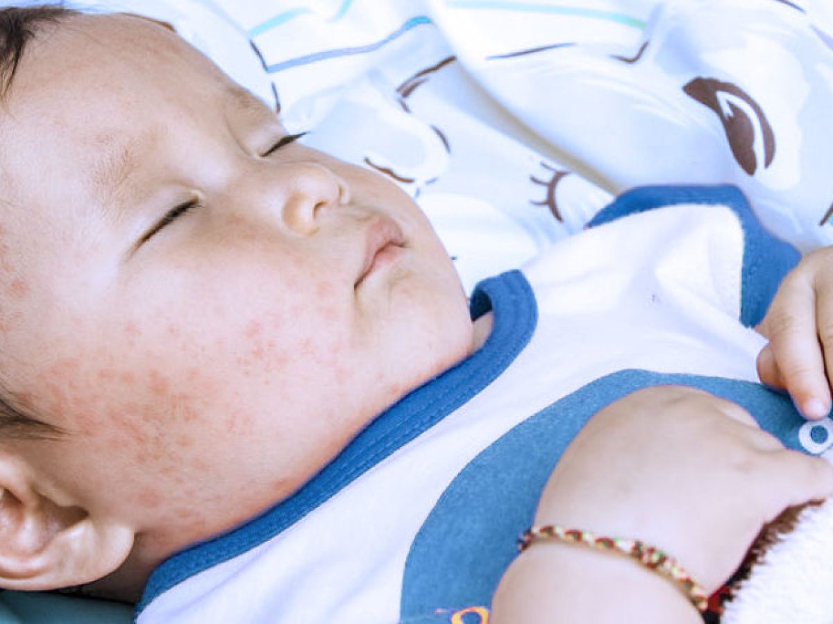 Exantema Viral Criancas RMMG Revista Médica De Minas Gerais Febre