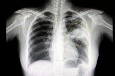 Pneumonia: o que é, sintomas, causas e tratamento