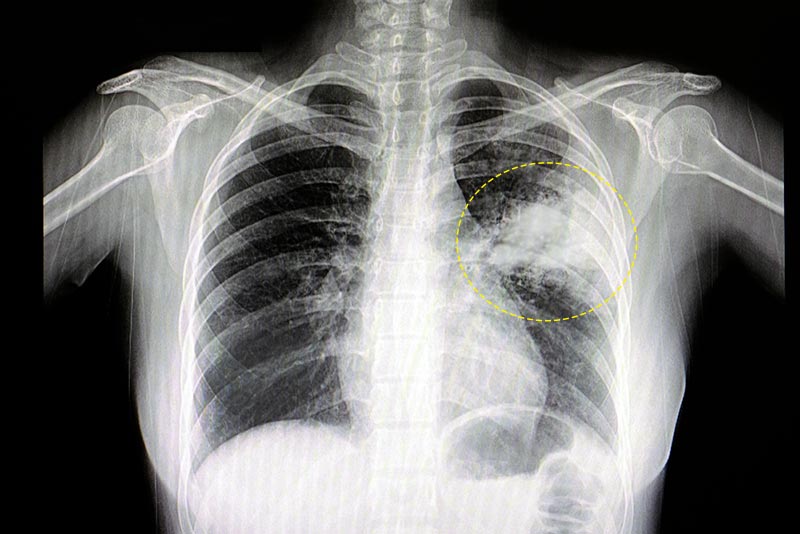 Pneumonia: o que é, sintomas, causas e tratamento
