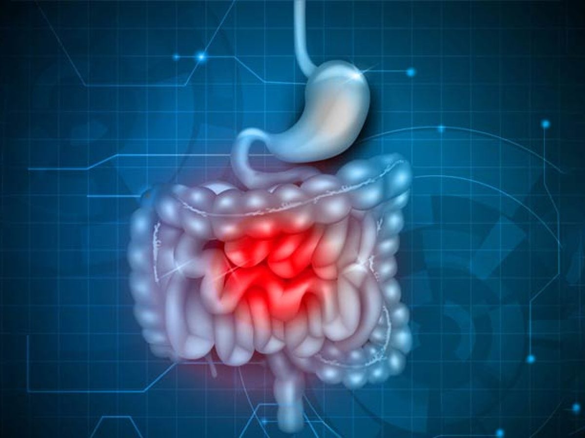 Heces Con Hematoquecia