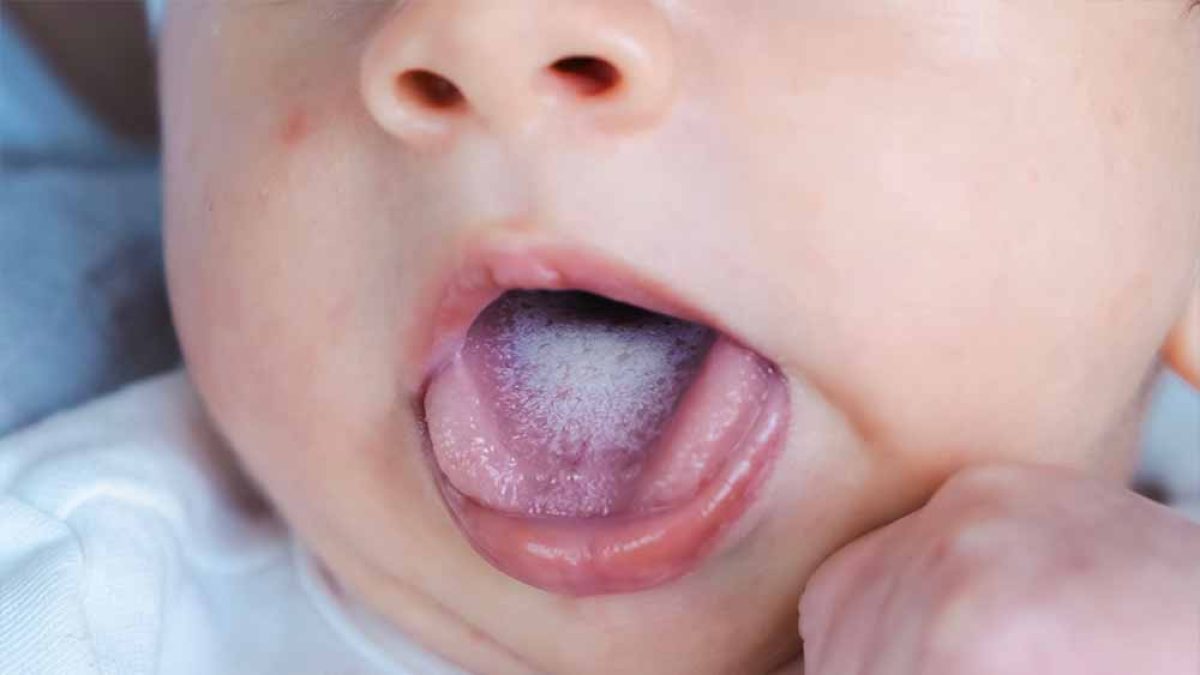 Bochecha De Sapinho Sapinho Em Bebê: 4 Passos Para Tratar E Como