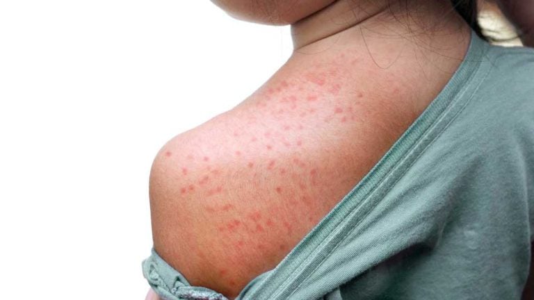 SARAMPO | Sintomas, transmissão, imagens e vacina