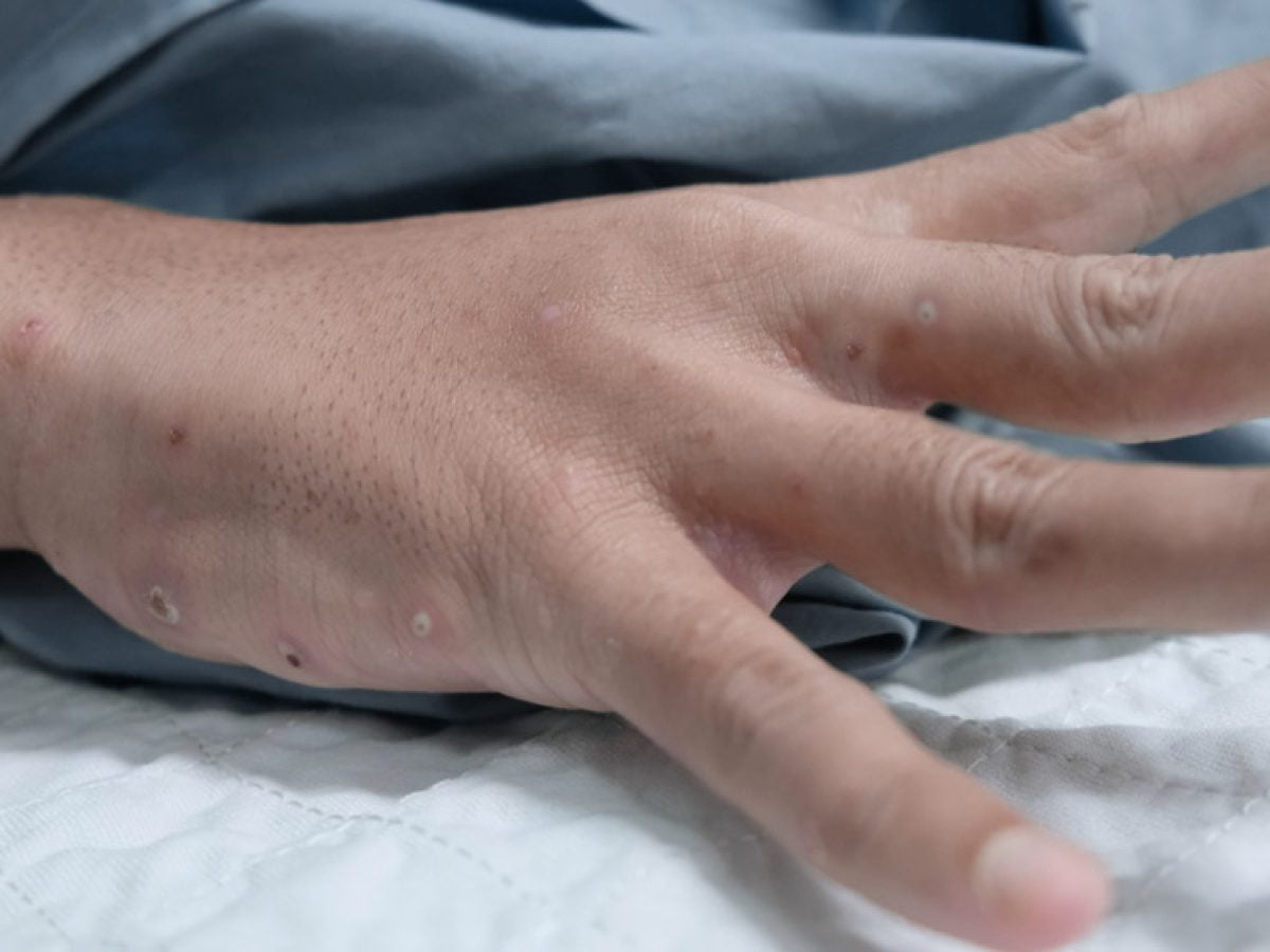 Estagios Iniciais Da Sarna Quais Os Perigos Da Escabiose (Sarna