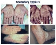 Pictures: Syphilis – All stages [Warning: Strong Images]