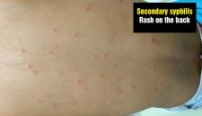 Pictures: Syphilis – All stages [Warning: Strong Images]