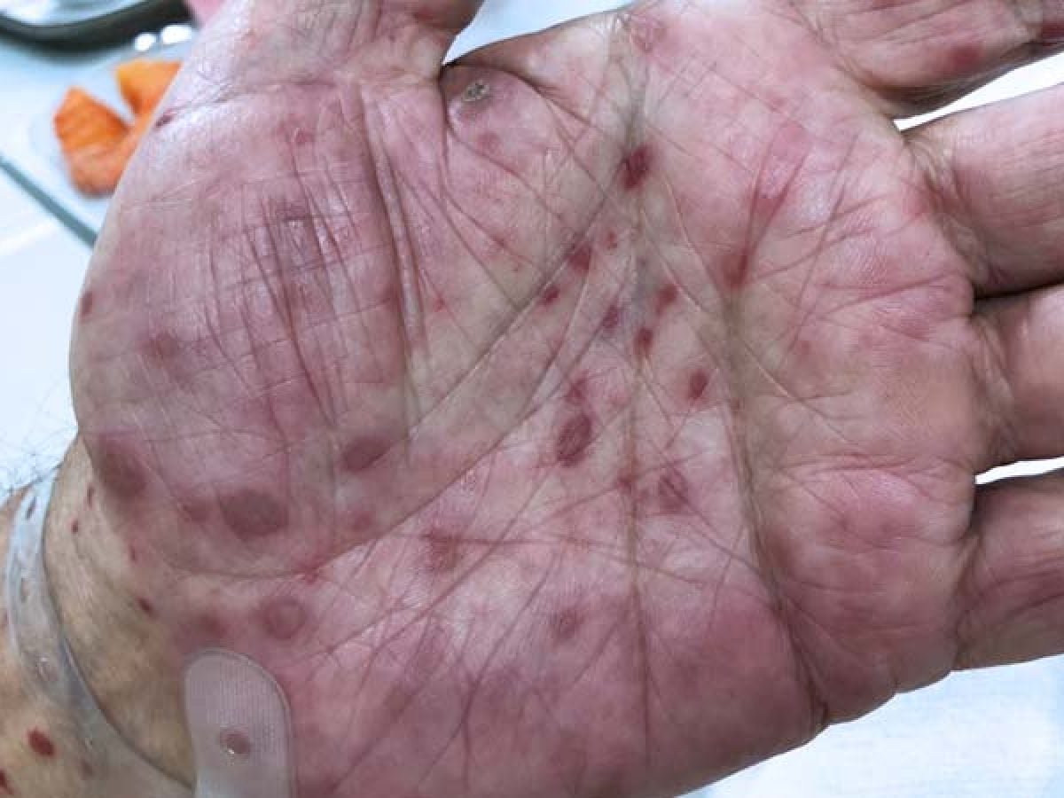 Síntomas De La Sífilis