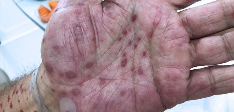 FOTOS DE SÍFILIS - Fases Precoce e Avançada | MD.Saúde