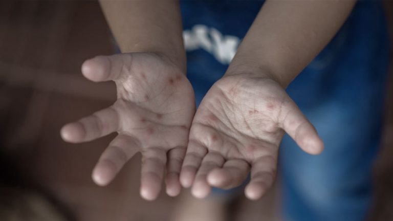 Caxumba | O que é, transmissão, sintomas e tratamento