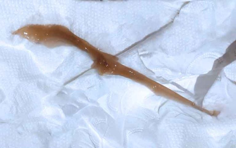 Teste de Schiller | Rastreio do câncer do colo do útero