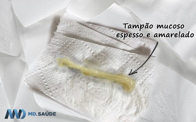 Tampão mucoso | O que é, como é, sintomas e fotos
