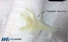 TAMPÃO MUCOSO | O que é, como é, sintomas e fotos