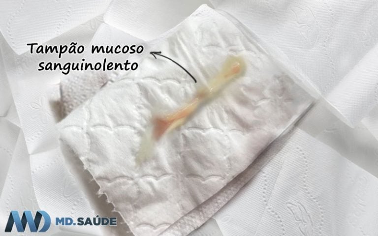 Tampão mucoso | O que é, como é, sintomas e fotos