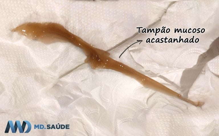 Tampão mucoso | O que é, como é, sintomas e fotos