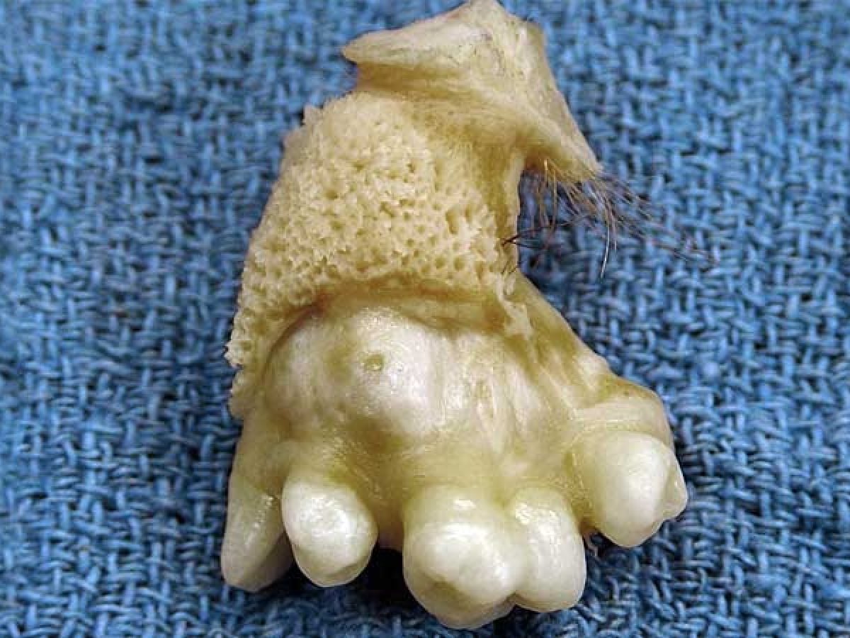 Remocao De Cisto Dermoide De Ovario Quem Tem Cisto Pode Engravidar?