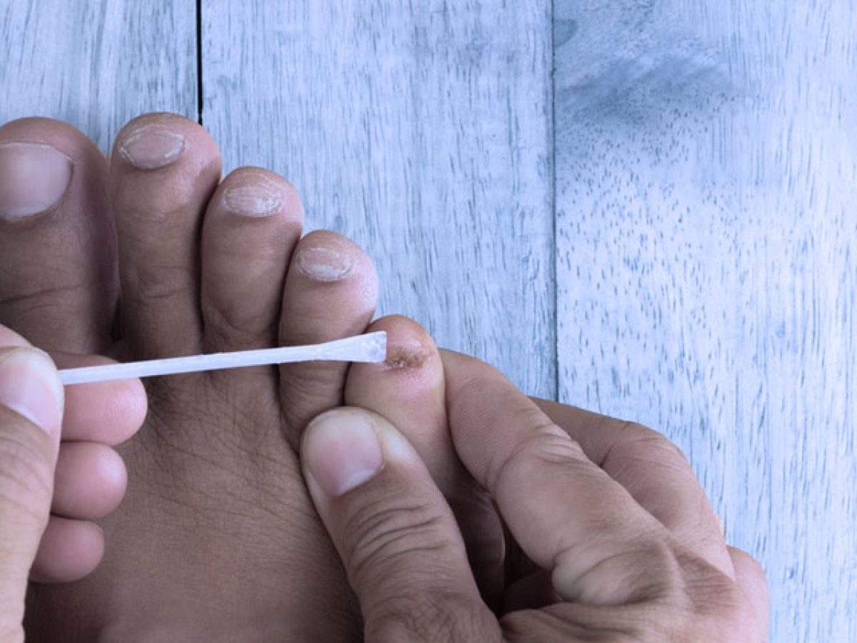 Terbinafina para que sirve: Combate infecciones fúngicas de forma ...