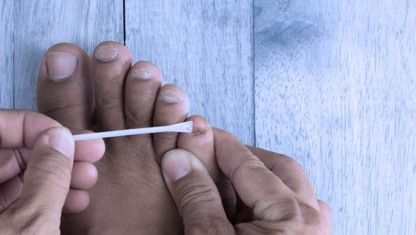 Tiña inguinal (tinea cruris): qué es, síntomas y tratamiento