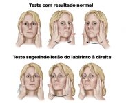 Labirintite: o que é, sintomas, causas e tratamento