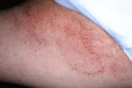 Fotos de tiña inguinal (tinea cruris)