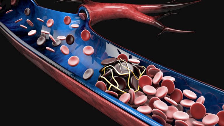 Trombose Venosa Profunda (TVP) - Trombose na Perna