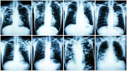 10 sintomas da tuberculose (pulmonar ou extrapulmonar)