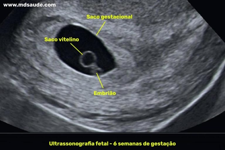 6 semanas de gravidez | Gestação semana a semana
