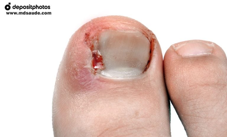 Fotos de doenças das unhas (micose, psoríase, infecções...)