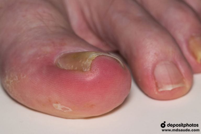Fotos de doenças das unhas (micose, psoríase, infecções...)